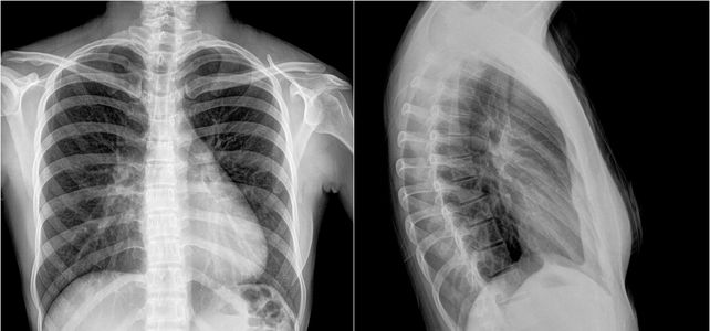 Show me your chest x-ray and I'll tell you your mortality risk